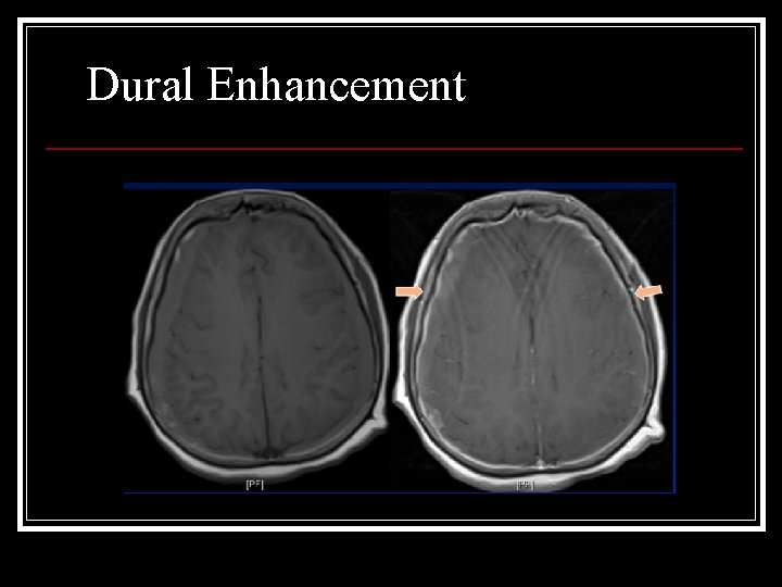 Headache Facial Pain Vincent T Martin MD FACP