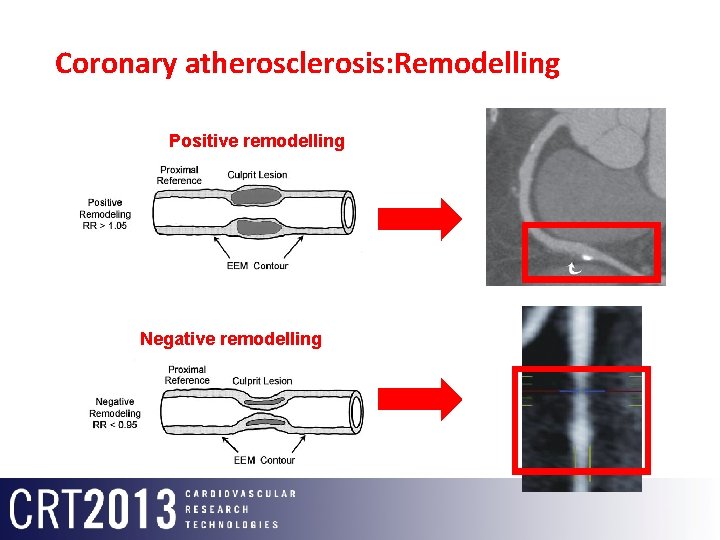 Prognostic Significance of Subtle Obstructive Lesions in Multislice