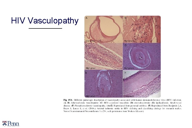 What is the role of HIV Vasculopathy in
