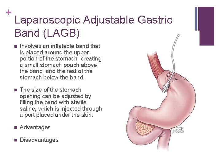 Gastric Bypass Complications Parenteral Nutrition By Adrienne Gebele