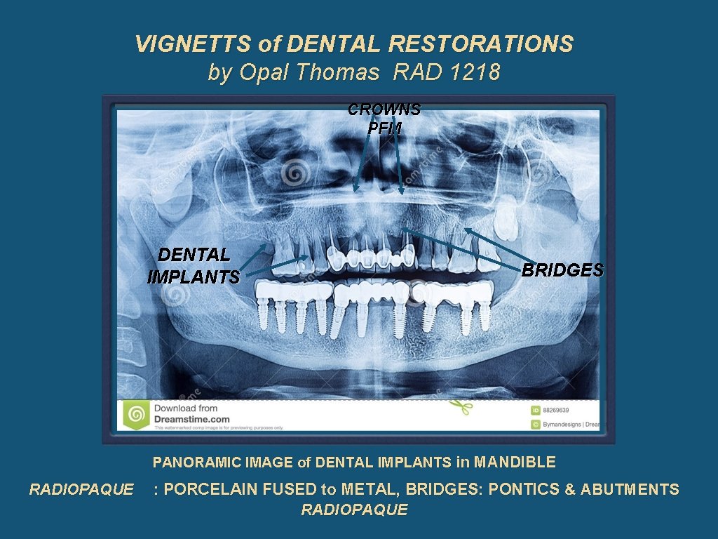 VIGNETTS of DENTAL RESTORATIONS by Opal Thomas RAD