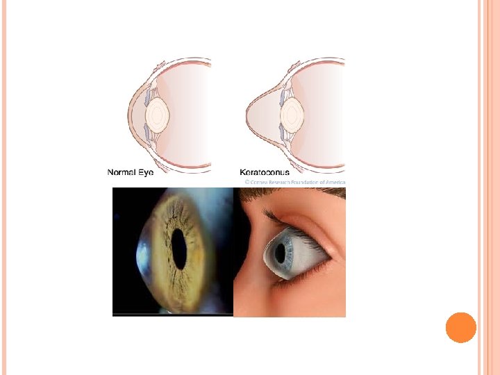 KERATOCONUS RGP Tamal Chakraborty B OPTM FIACLE India