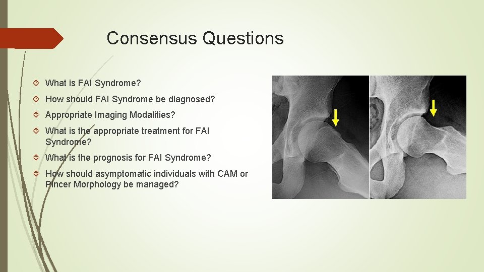Hip Update 2017 Femoroacetabular Impingement FAI May 26