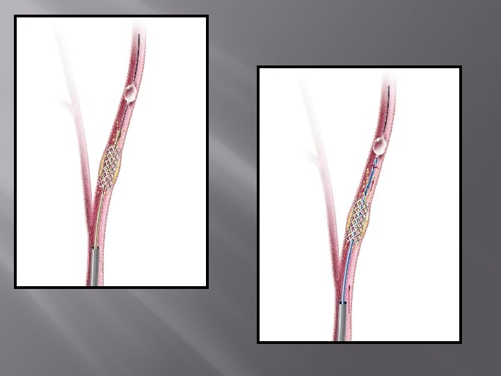 Guard Wire Plus Guard Wire Plus Export Aspiration