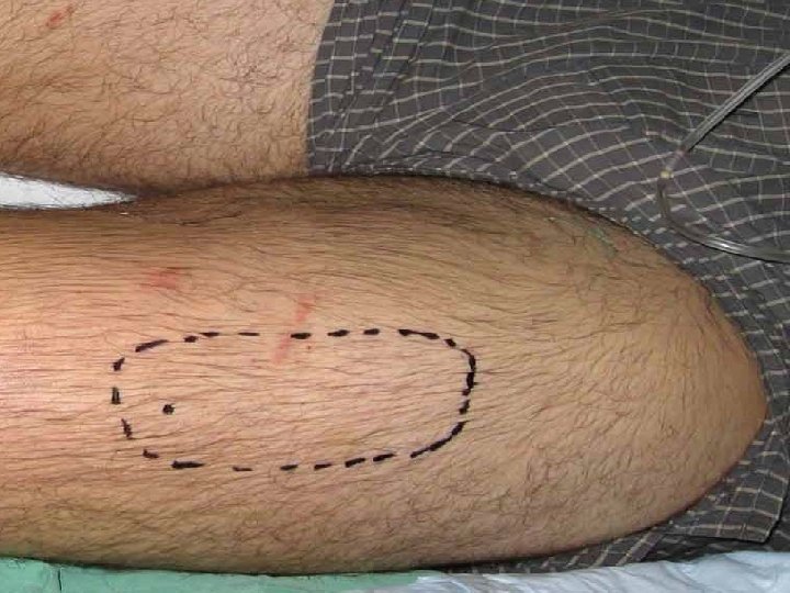 Syndrome des loges Rappels anatomiques Physiopathologie Lien du