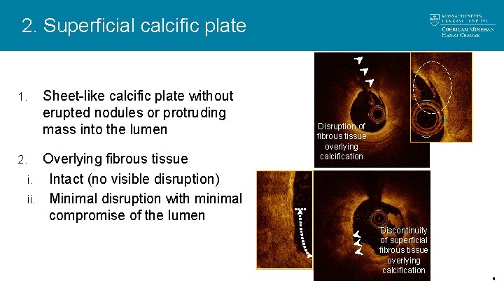 A new classification of calcified plaques in patients