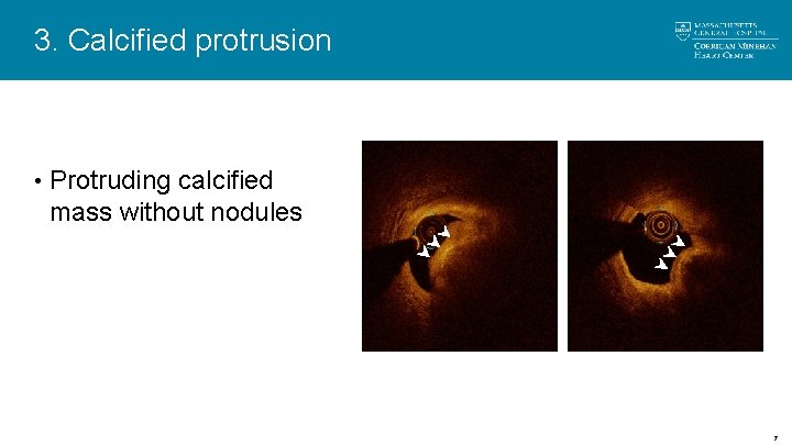 A new classification of calcified plaques in patients