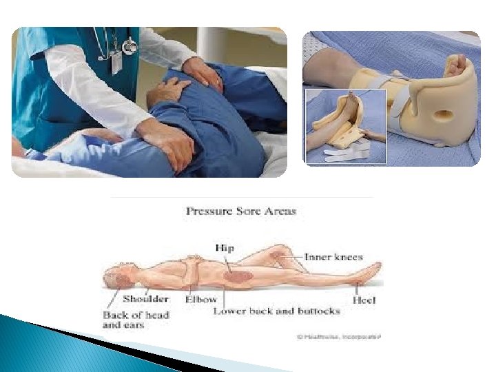 Pressure Ulcer Dr Hourvash Ebrahimi Bedsores also called