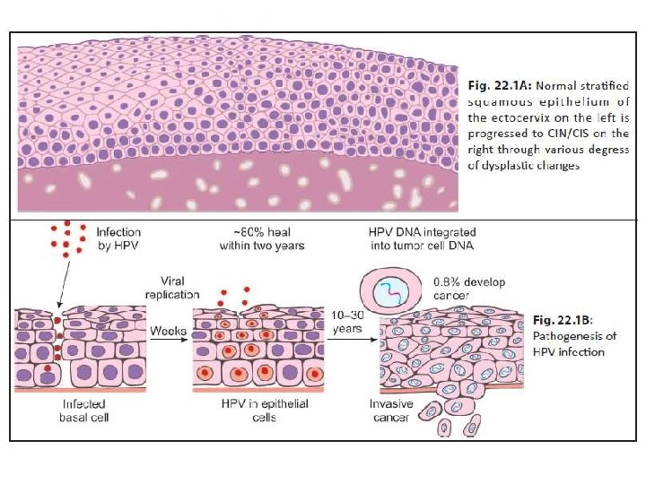 Cancer cervix preinvasive Dr Osama El ashkar Cervical