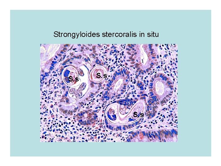 Strongyloides stercoralis Anguillula stercoralis Bavay 1876 Geographic ...