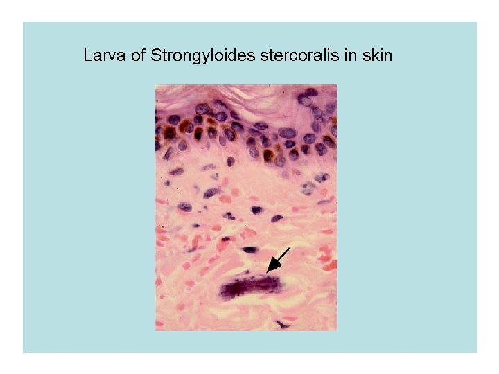 Strongyloides stercoralis Anguillula stercoralis Bavay 1876 Geographic ...