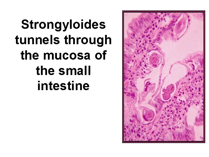 Strongyloides stercoralis Anguillula stercoralis Bavay 1876 Geographic ...