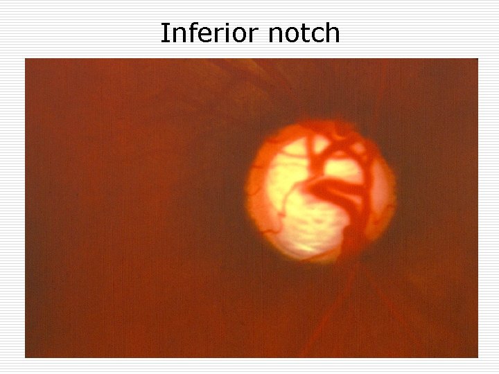 Understanding GLAUCOMA The Science Behind Current Testing and
