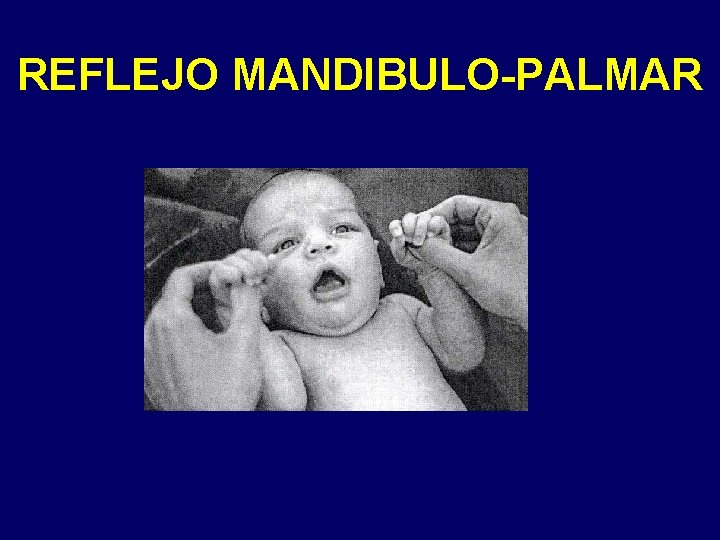 PARALISIS CEREBRAL INFANTIL Dr Mauricio De los Ros