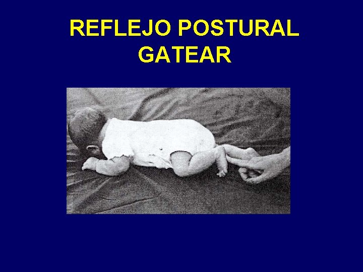 PARALISIS CEREBRAL INFANTIL Dr Mauricio De los Ros