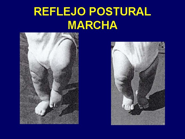 PARALISIS CEREBRAL INFANTIL Dr Mauricio De los Ros