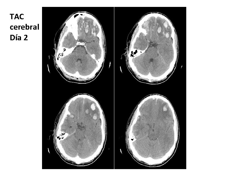 Trauma Encefalocraneano TEC Trauma Encefalocrran eano TEC Atencin