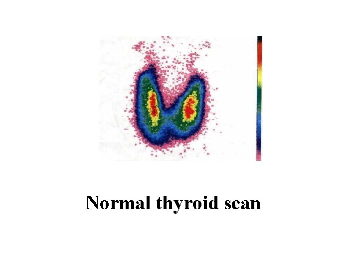 Thyrotoxicosis Hyperthyroidism evaluation management Mohsen Eledrisi MD ...
