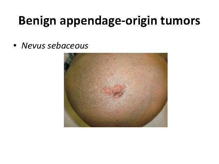 In the name of god Benign cutaneous and