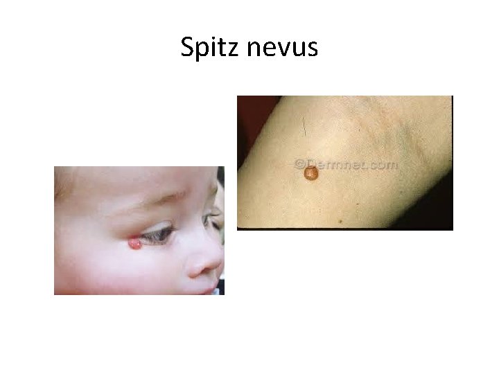 In the name of god Benign cutaneous and