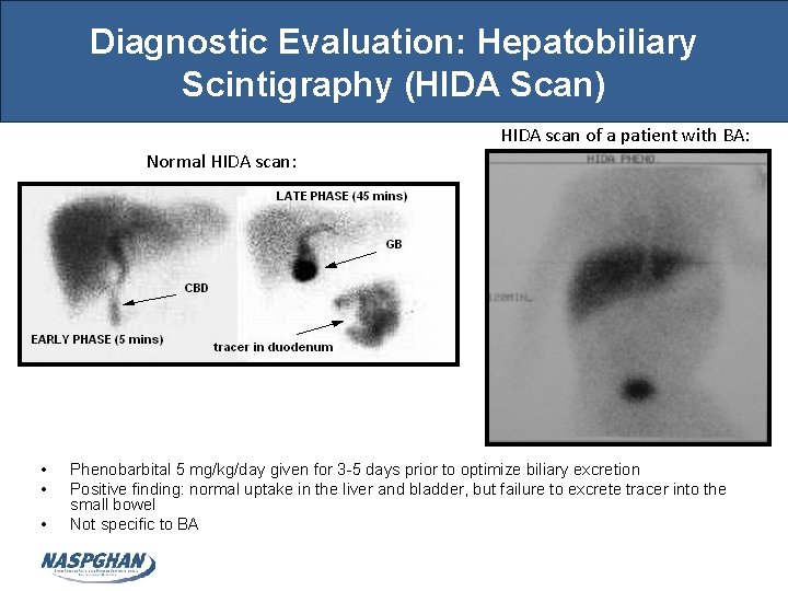 Biliary Atresia Kimberley Chien MD Mercedes Martinez MD