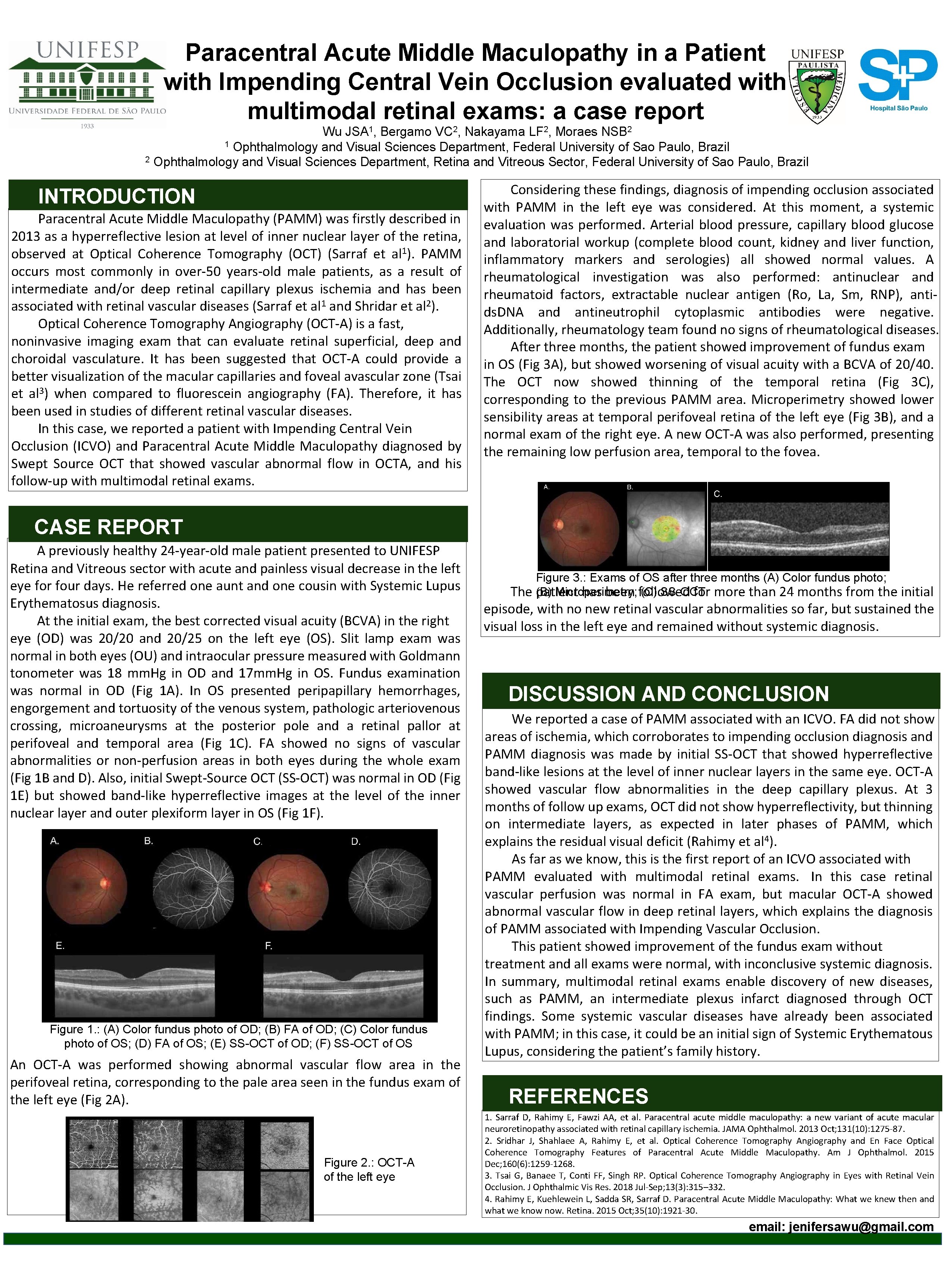 Paracentral Acute Middle Maculopathy in a Patient with
