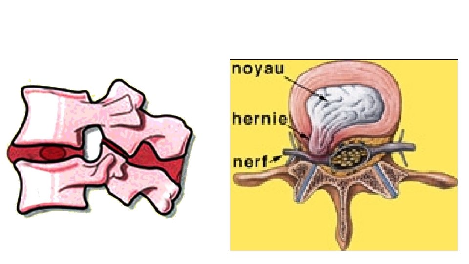 Hernie discale Dr DIALLO Moussa Service de neurochirurgie