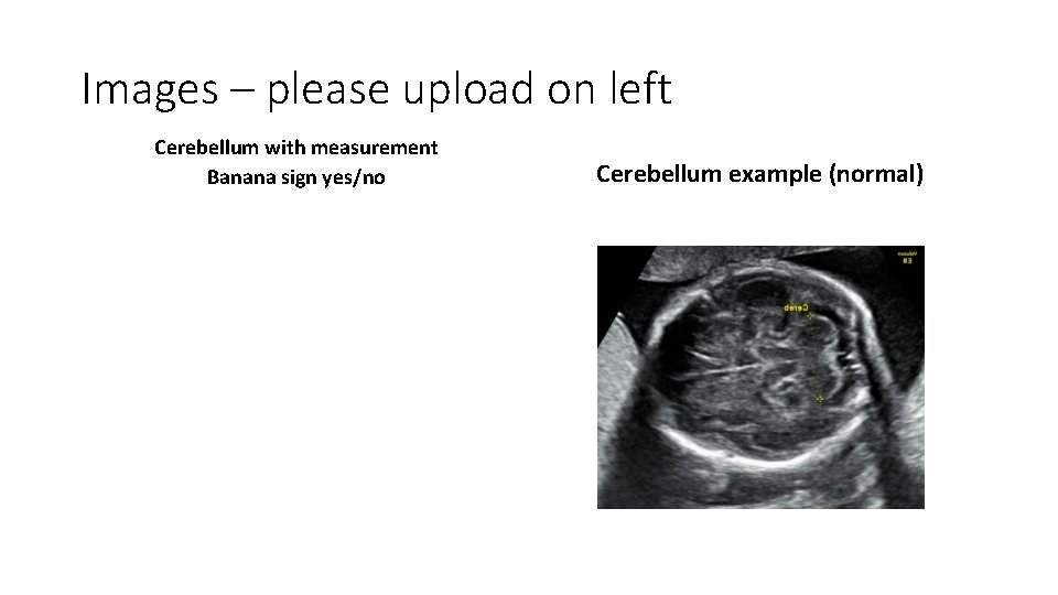 UZ Leuven UCLH Fetal spina bifida repair program