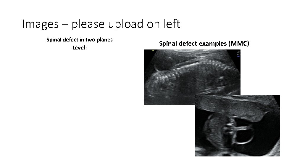 UZ Leuven UCLH Fetal spina bifida repair program
