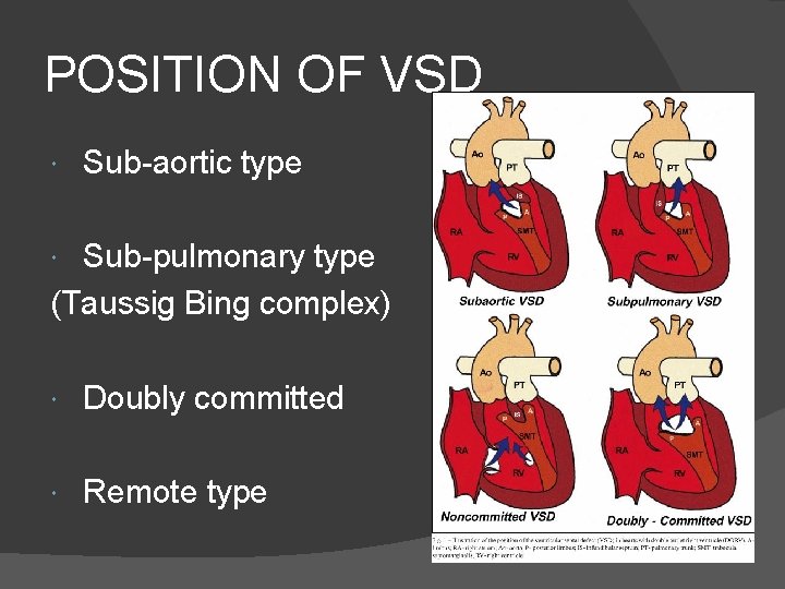 DOUBLE OUTLET RIGHT VENTRICLE Dr Kshitij Mavade Introduction