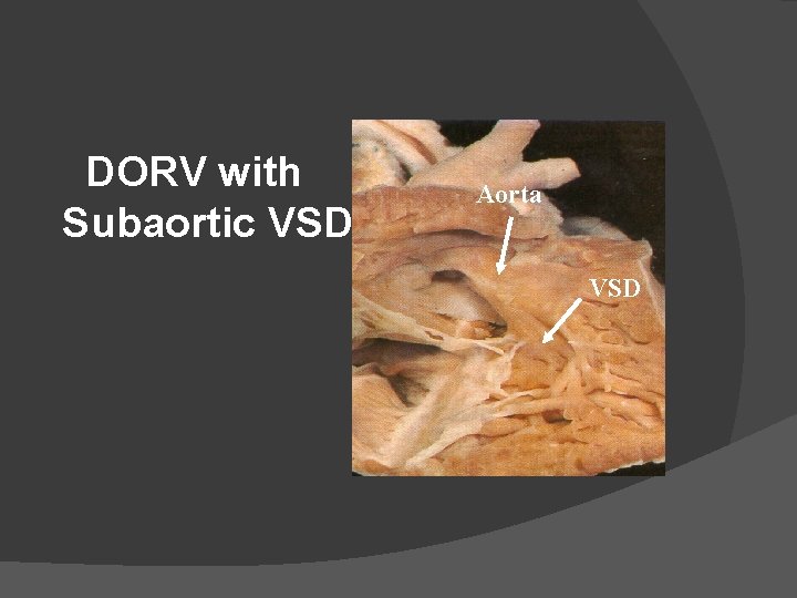 DOUBLE OUTLET RIGHT VENTRICLE Dr Kshitij Mavade Introduction