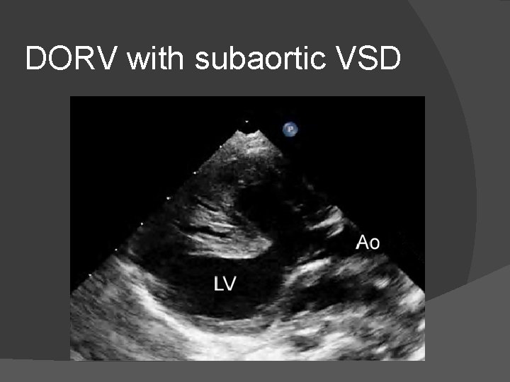 DOUBLE OUTLET RIGHT VENTRICLE Dr Kshitij Mavade Introduction