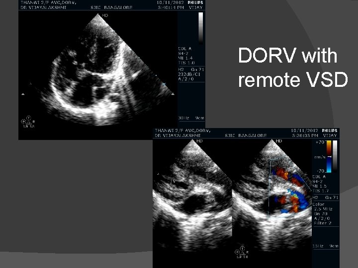 DOUBLE OUTLET RIGHT VENTRICLE Dr Kshitij Mavade Introduction