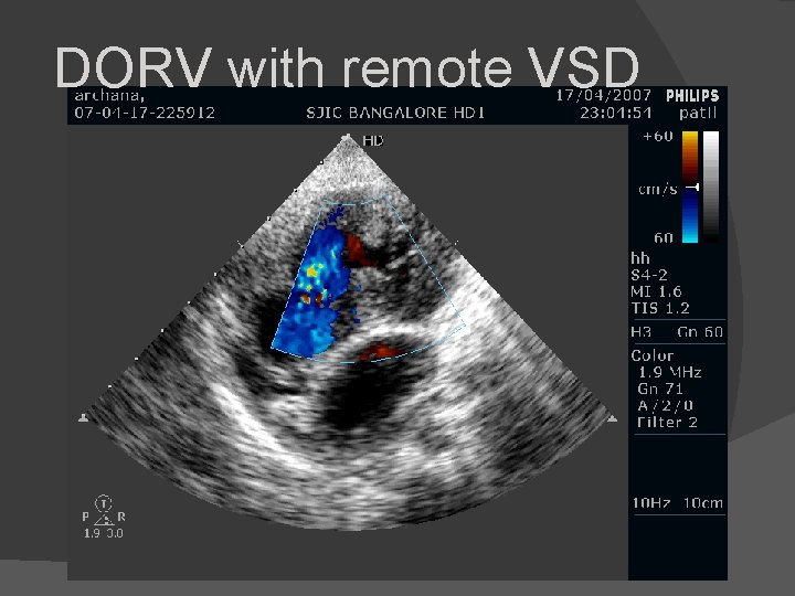 DOUBLE OUTLET RIGHT VENTRICLE Dr Kshitij Mavade Introduction