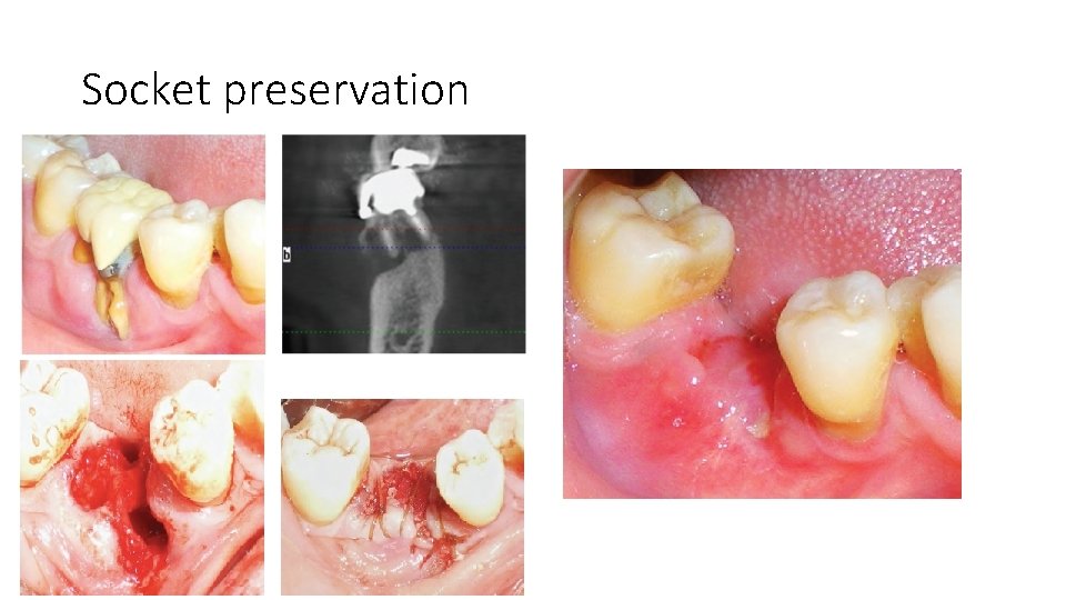 Preprosthetic surgeries Ideal ridge Goodsell Adequate bony support