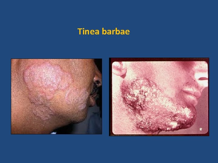 Superficial Cutaneous and Subcutaneous Fungal Infections Jarrod Fortwendel