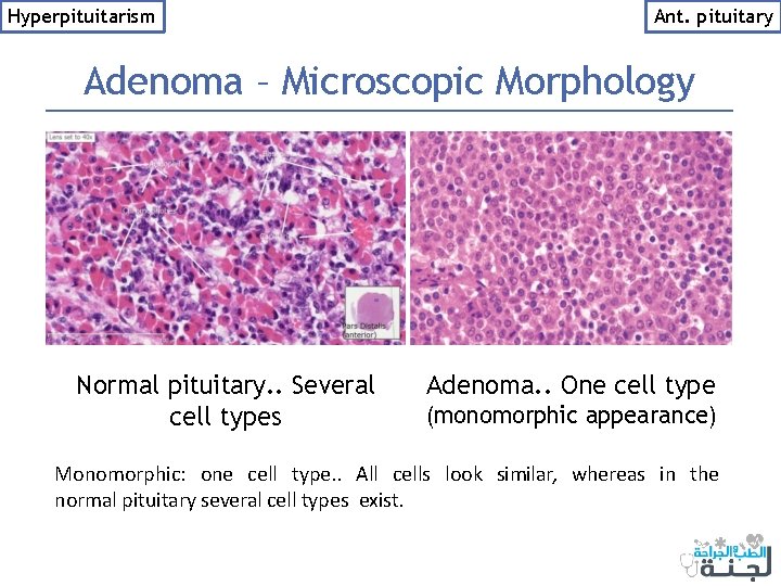 Pituitary gland Pathology Symptoms and signs of pituitary