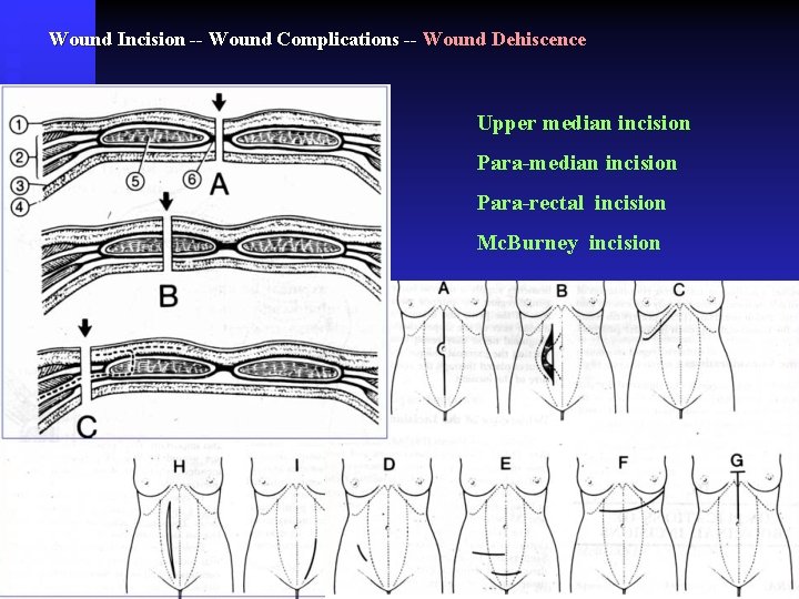 General Complications 1 Wound Complications Postoperative Parotiditis ...