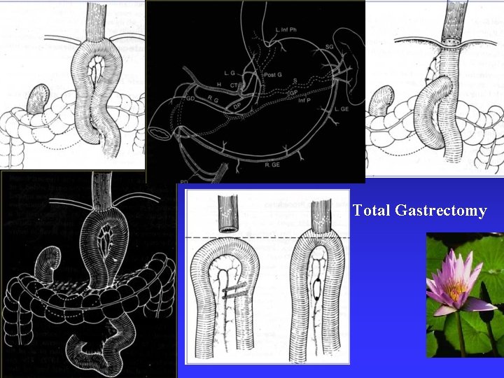 General Complications 1 Wound Complications Postoperative Parotiditis ...