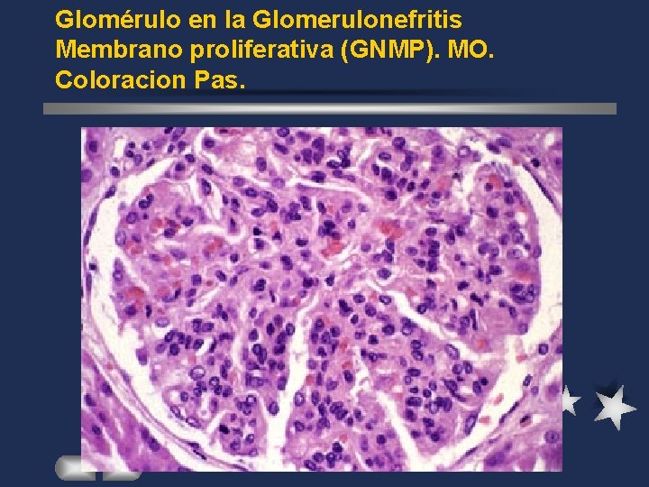 Glomerulonefritis membranoproliferativa GNMP Glomerulonefritis ...