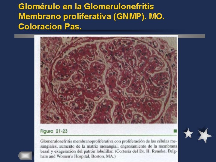 Glomerulonefritis membranoproliferativa GNMP Glomerulonefritis ...