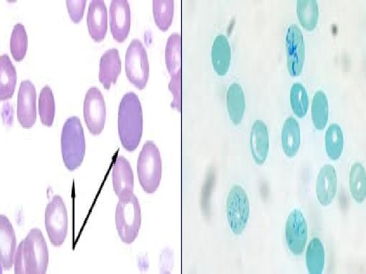 Practical Hematology Lab LAB 5 Reticulocyte Count Reticulocyte