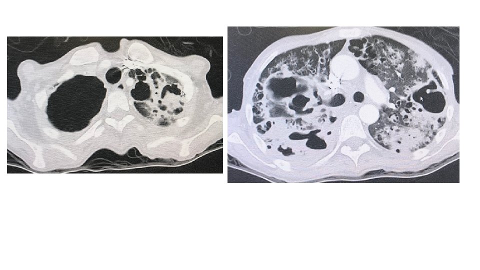 Tuberculosis in the NT Professor Anna Ralph Infectious