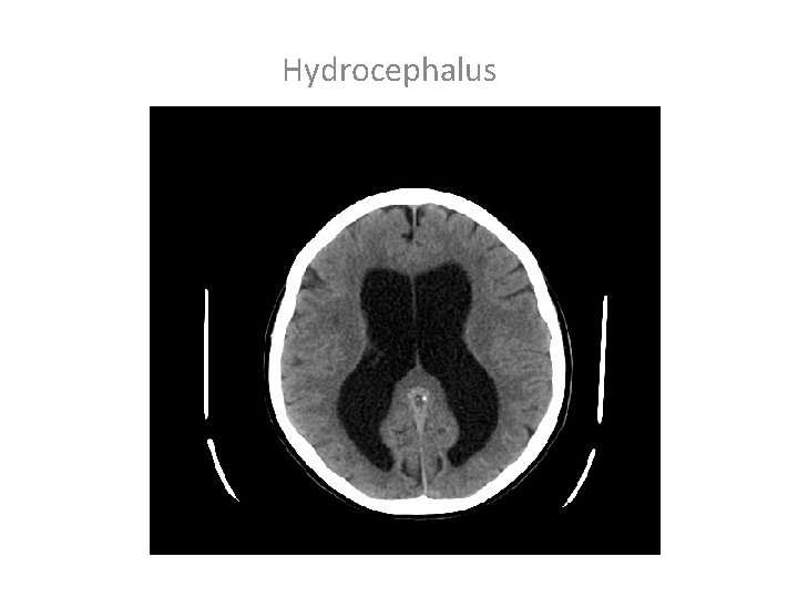 Ventricles of the Brain DR T AJAYAN PROF