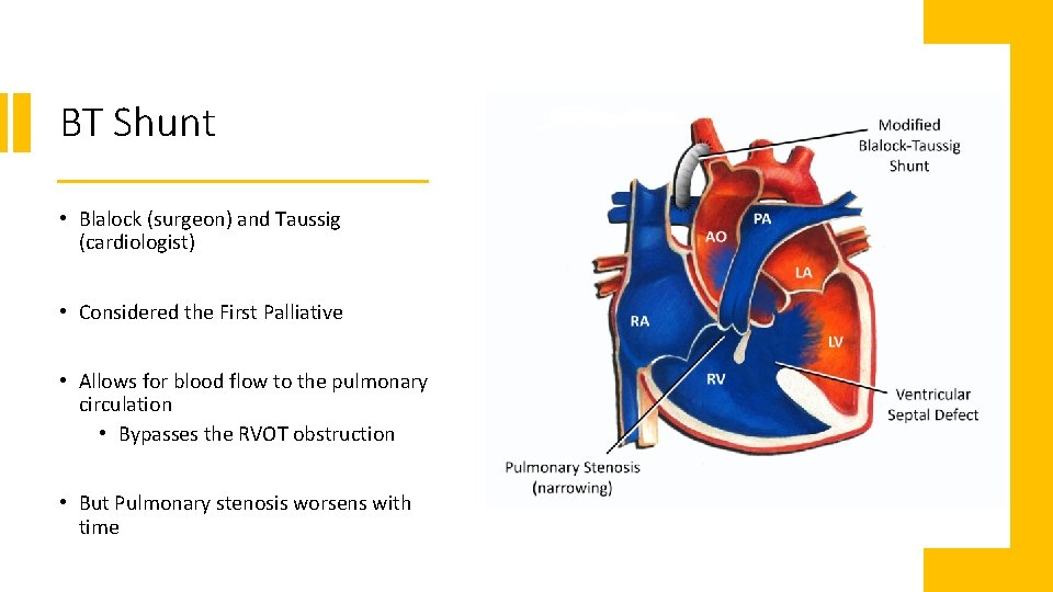 Tetralogy of Fallot Amogh Kambalyal MDPGY 1 Anatomy