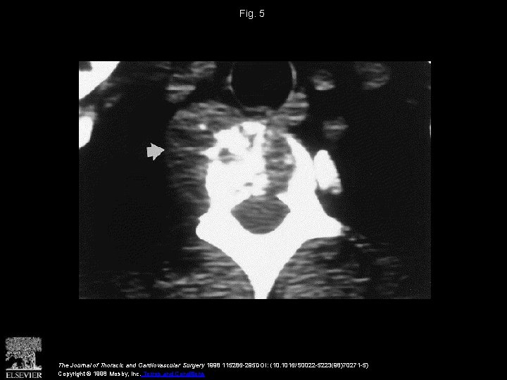 Cervicothoracic Tumors Results Of Resection By The HemiClamshell