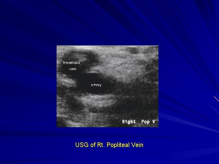 Deep Vein Thrombosis Malignancy Department of Radiation Oncology