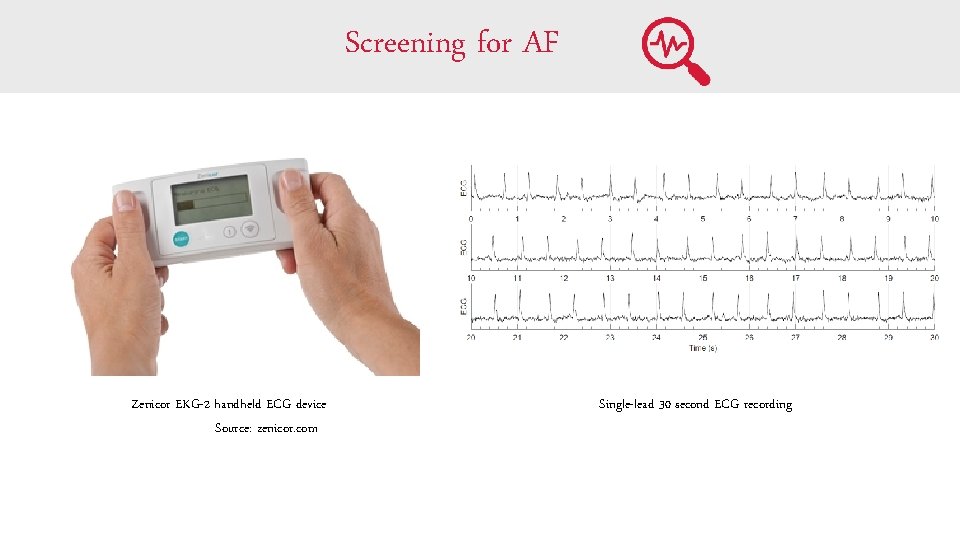 Screening for atrial fibrillation improving efficiency of manual
