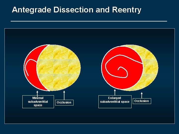 Subintimal Tracking and Reentry Indications Technique Acute and