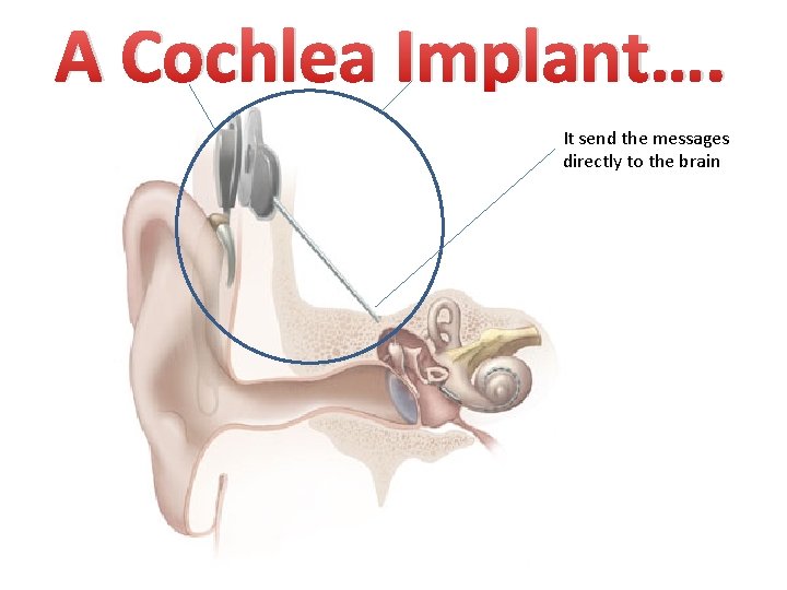 Your Ear Cochlea Implant A cochlear implant CI